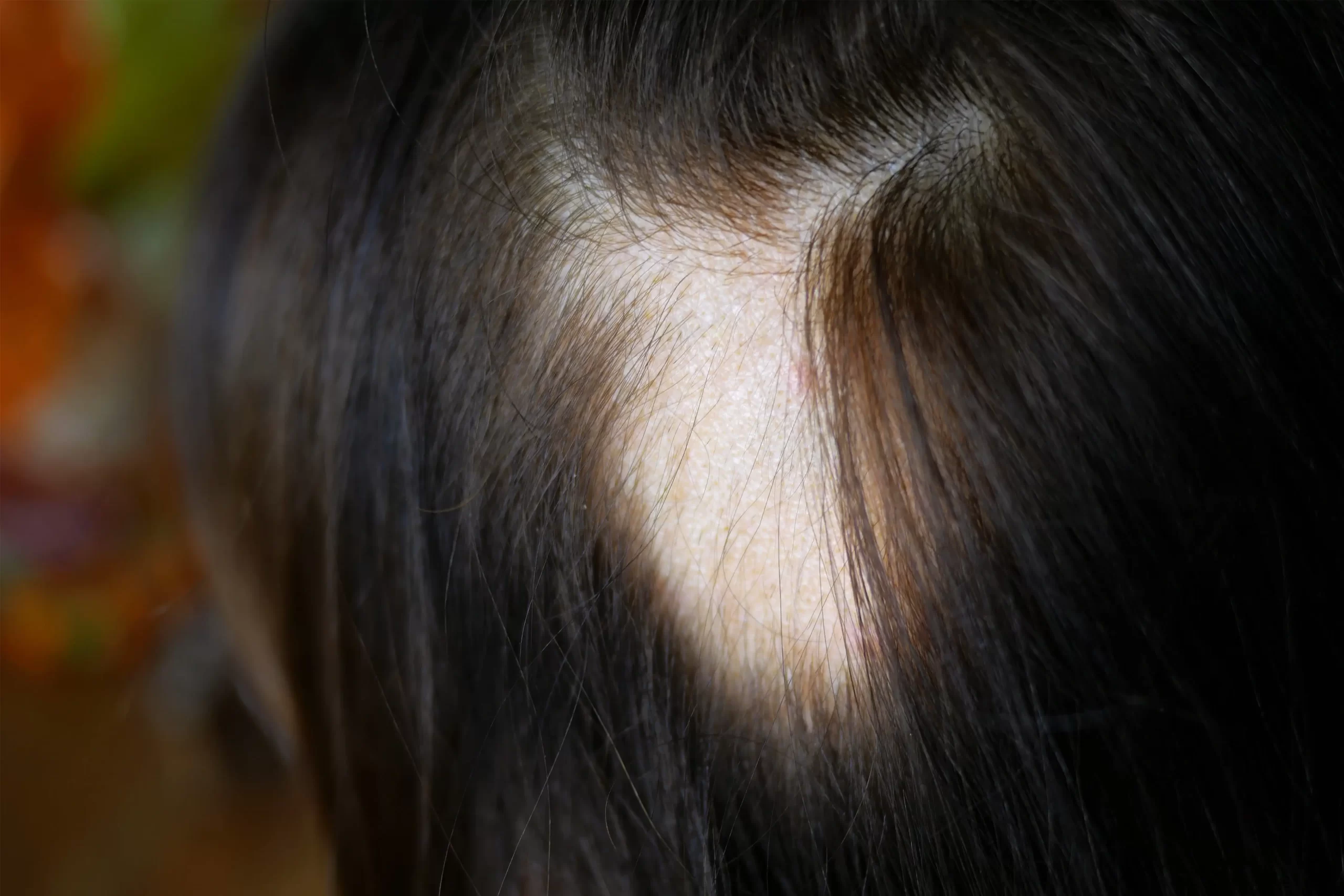 ALOPECIA AREATA - Clínica Ideal
