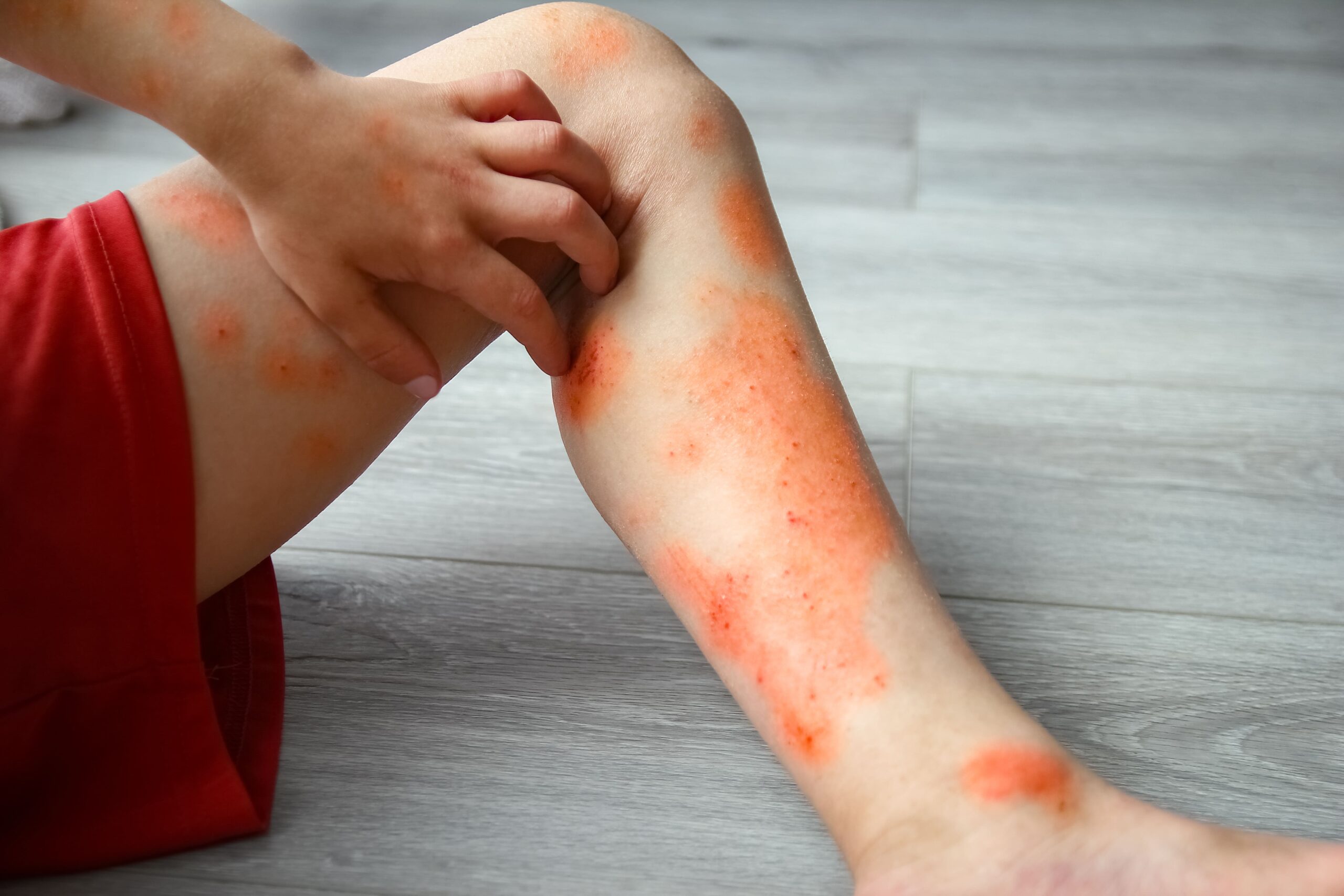 Dermatite Atopica Em Adultos