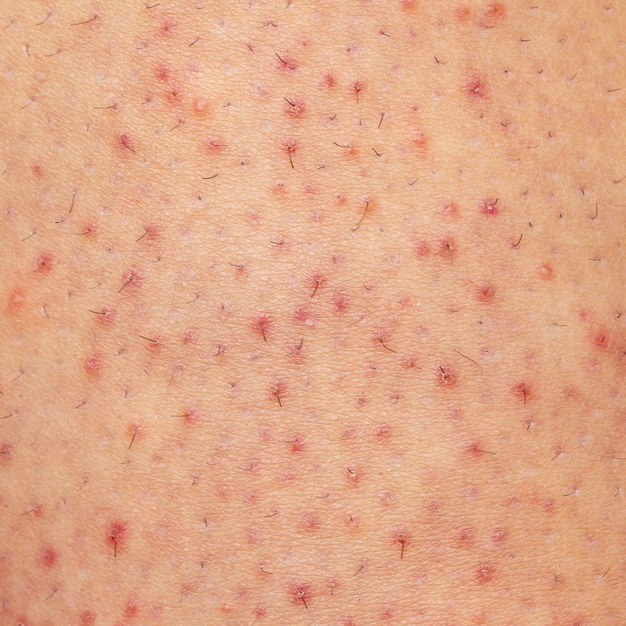 FOLICULITE: SAIBA COMO TRATAR - Clínica Ideal